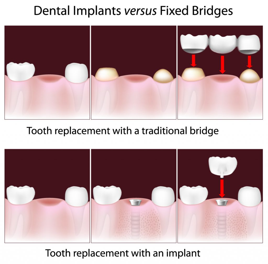 Single Tooth Dental Implants Hillsborough NJ Single Tooth Dental Implants Hillsborough NJ
