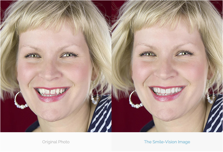 Porcelain Dental Veneers Hillsborough New Jersey NJ